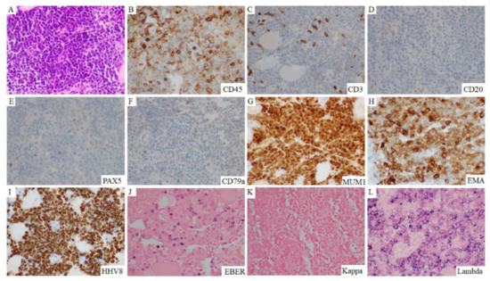 Primary Effusion Lymphoma: A Clinicopathological Study of 70 Cases