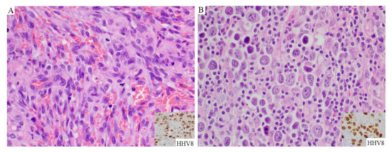 Primary Effusion Lymphoma: A Clinicopathological Study of 70 Cases