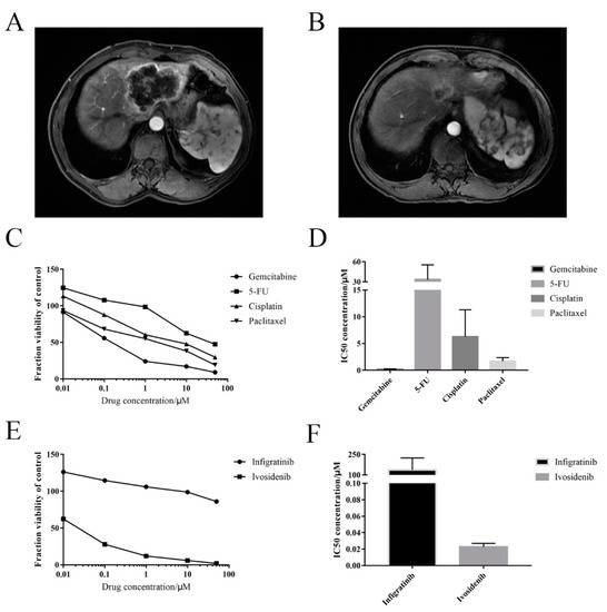 Conversion Therapy of Intrahepatic Cholangiocarcinoma Is Associated ...