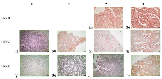 The Prognostic Role of LRIG Proteins in Endometrial Cancer