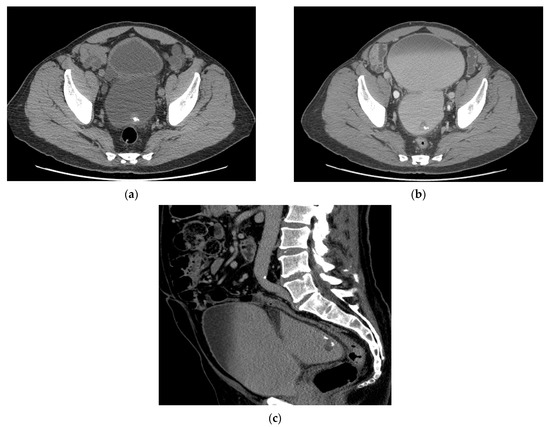 Imaging and Management of Bladder Cancer