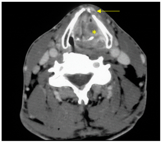 Total Laryngectomy—Still Cutting-Edge?