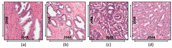 Artificial Intelligence Techniques for Prostate Cancer Detection ...