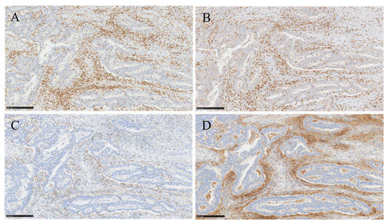Cancers | Free Full-Text | Immune Contexture of MMR-Proficient Primary ...