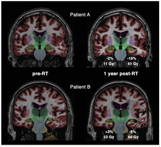 MR Image Changes of Normal-Appearing Brain Tissue after Radiotherapy
