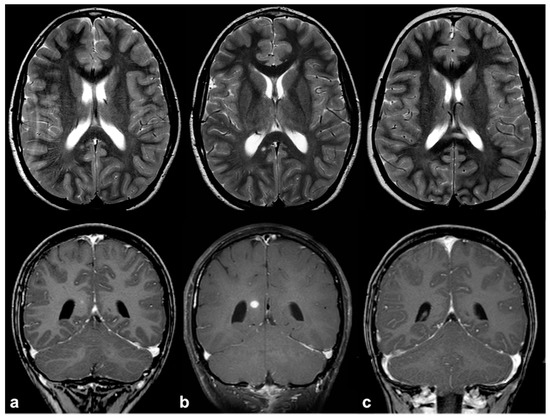Non-Oncological Neuroradiological Manifestations in NF1 and Their ...