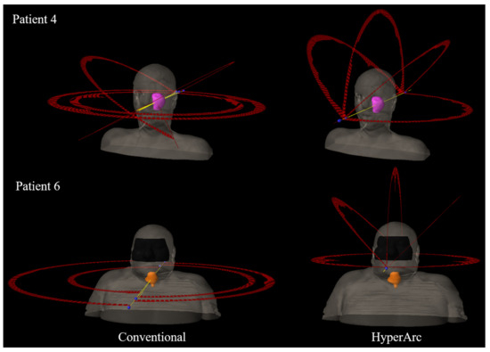 Automated Non-Coplanar VMAT for Dose Escalation in Recurrent Head and Neck Cancer Patients