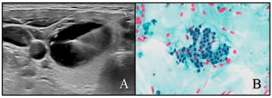 Diagnostic Performances of the ACR-TIRADS System in Thyroid Nodules ...