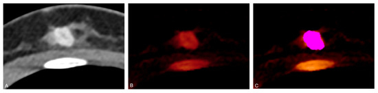 Cancers | Free Full-Text | Iodine Map Radiomics in Breast Cancer ...