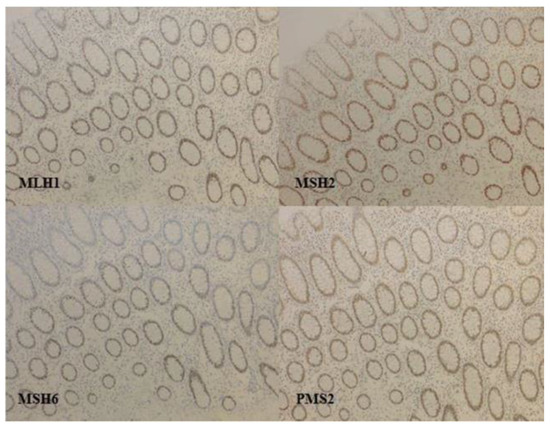 Predictive and Prognostic Value of Microsatellite Instability in ...