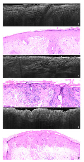 In-Vivo LC-OCT Evaluation of the Downward Proliferation Pattern of ...