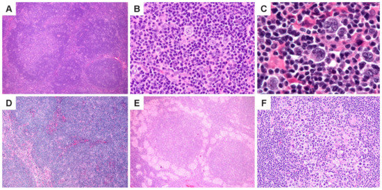 Pitfalls in the Diagnosis of Nodular Lymphocyte Predominant Hodgkin Lymphoma: Variant Patterns ...