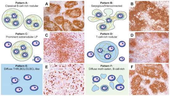 Pitfalls in the Diagnosis of Nodular Lymphocyte Predominant Hodgkin ...