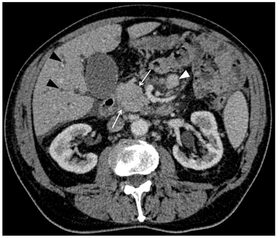 Utility of CT to Differentiate Pancreatic Parenchymal Metastasis from ...
