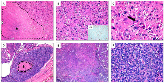 Poorly Differentiated and Anaplastic Thyroid Cancer: Insights into ...