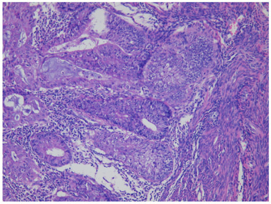 Prediction of Myometrial Invasion in Stage I Endometrial Cancer by MRI ...