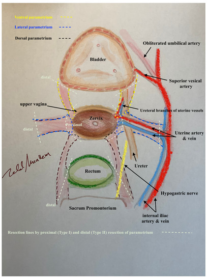A New Anatomic and Staging-Oriented Classification of Radical Hysterectomy