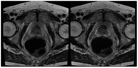 Accelerated T2-Weighted TSE Imaging of the Prostate Using Deep Learning ...