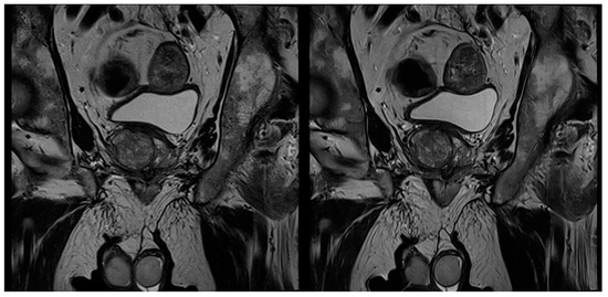 Cancers Free Full Text Accelerated T2 Weighted Tse Imaging Of The