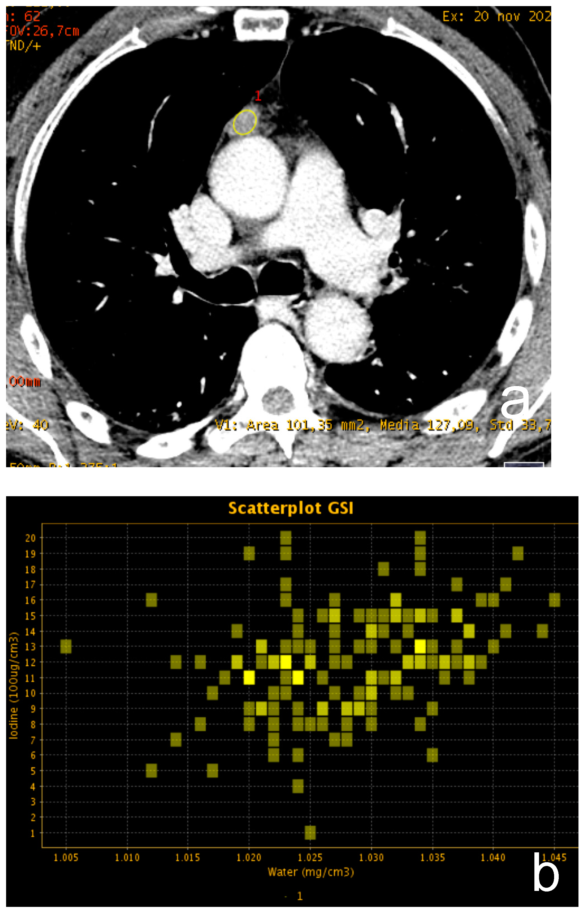 Advancement in Diagnostic Imaging of Thymic Tumors