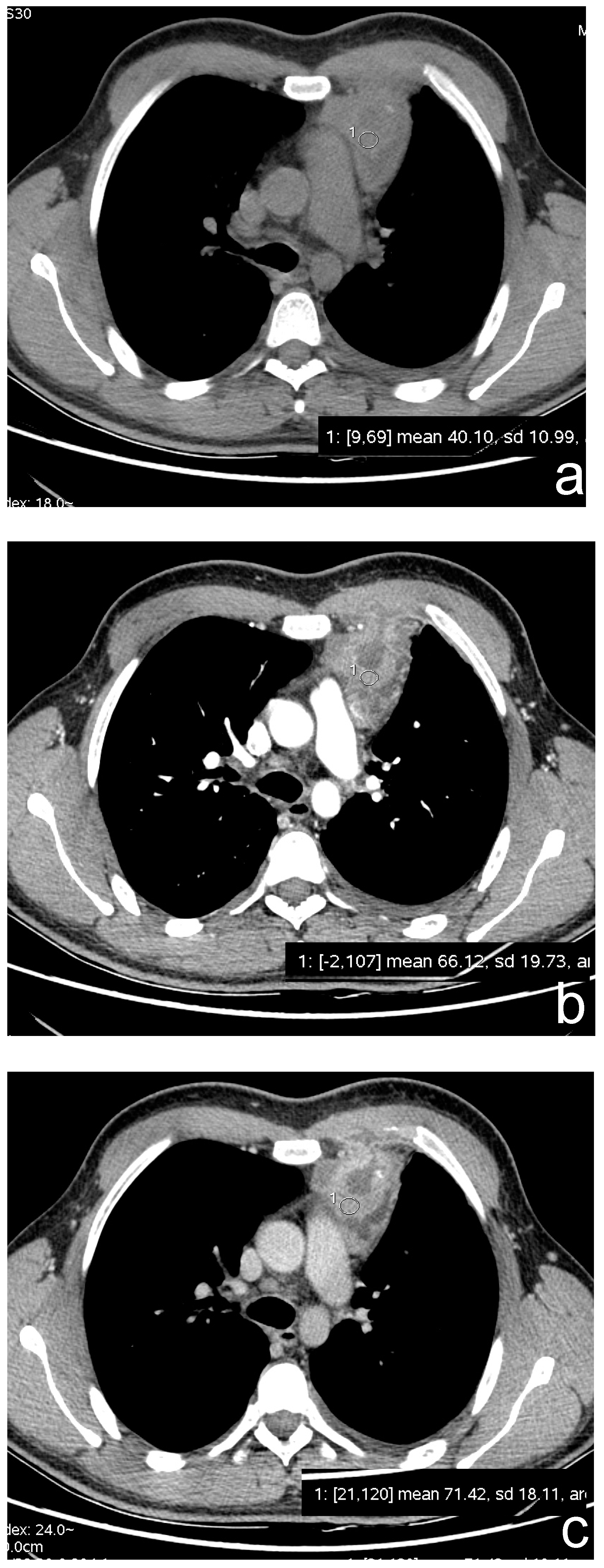 Advancement in Diagnostic Imaging of Thymic Tumors