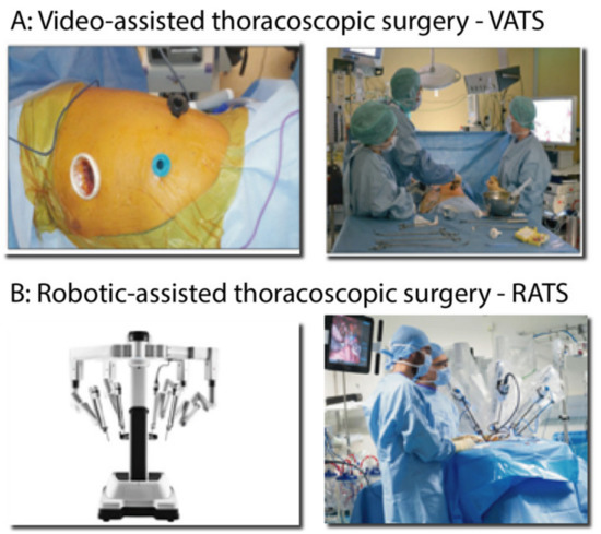 The Role of Surgery in Lung Cancer Treatment: Present Indications and ...
