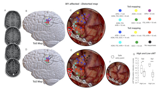 Targeting Primary Motor Cortex (M1) Functional Components in M1 Gliomas ...