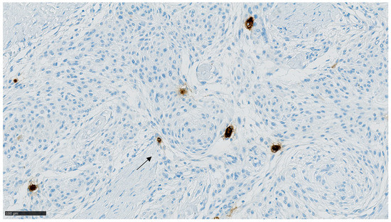 Pathologic Characteristics of Pregnancy-Related Meningiomas