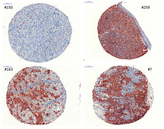 Distinct Molecular Mechanisms of Altered HLA Class II Expression in ...