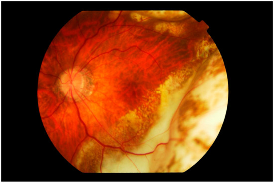 Vitreoretinal Lymphoma