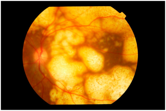 Vitreoretinal Lymphoma