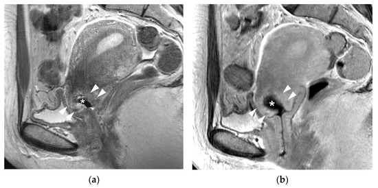 Useful MRI Findings for Minimally Invasive Surgery for Early Cervical ...