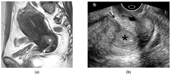 Useful MRI Findings for Minimally Invasive Surgery for Early Cervical ...