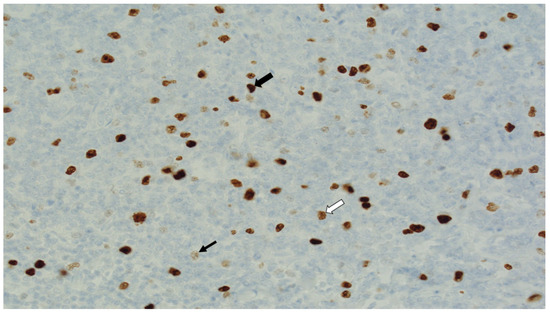 Ki-67 as a Prognostic Biomarker in Invasive Breast Cancer