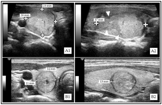 Diagnostic Performance of Kwak, EU, ACR, and Korean TIRADS as Well as ...