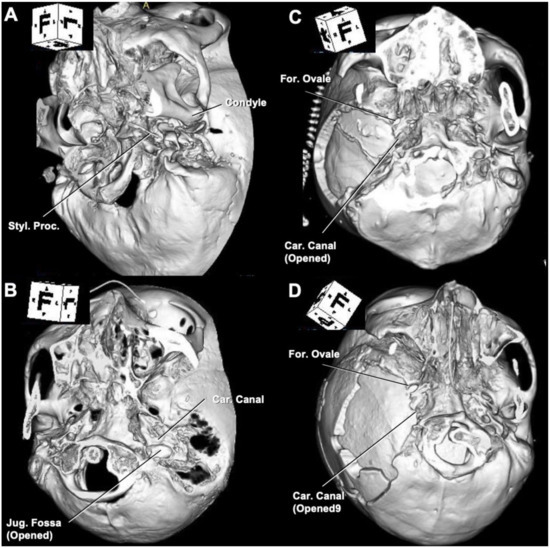 Variations of en Bloc Resection for Advanced External Auditory Canal ...