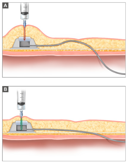A Modified Intraperitoneal Chemotherapy Regimen for Ovarian Cancer ...