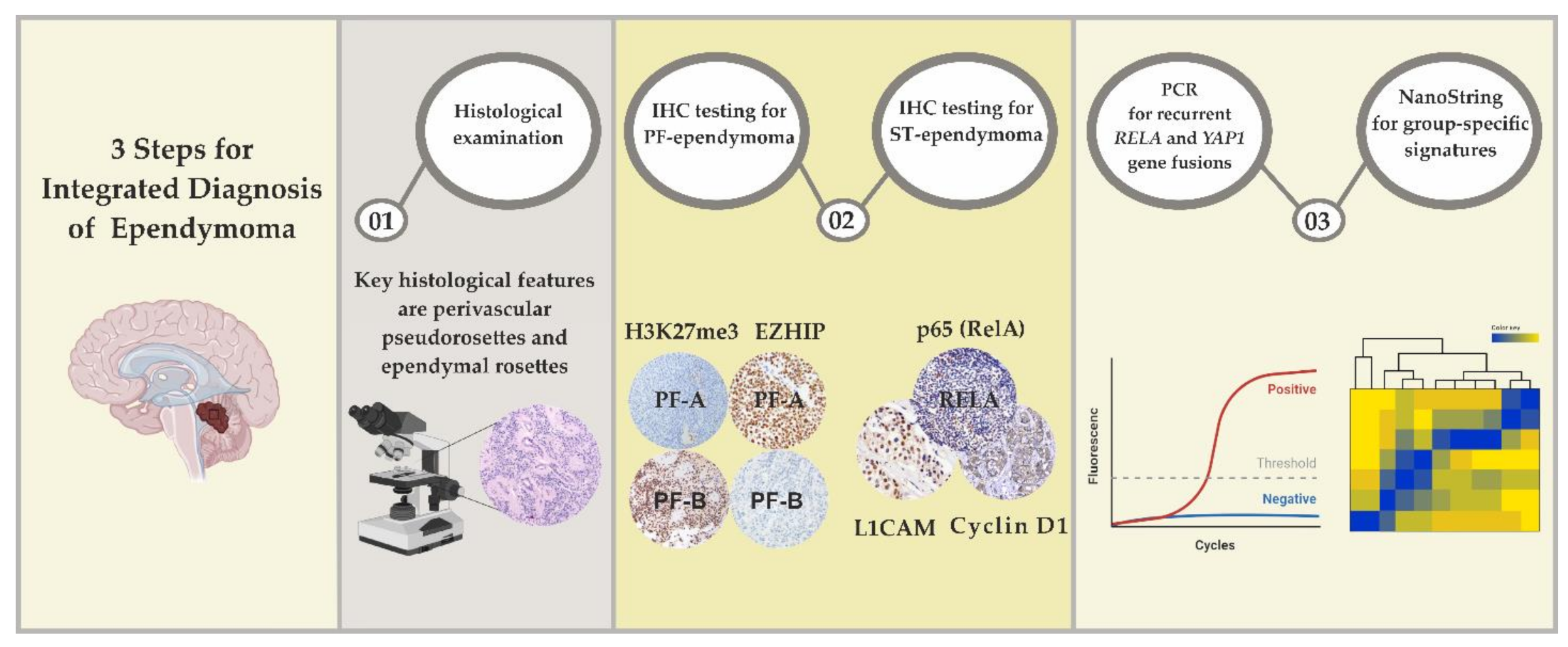 Molecular Stratification of Childhood Ependymomas as a Basis for ...