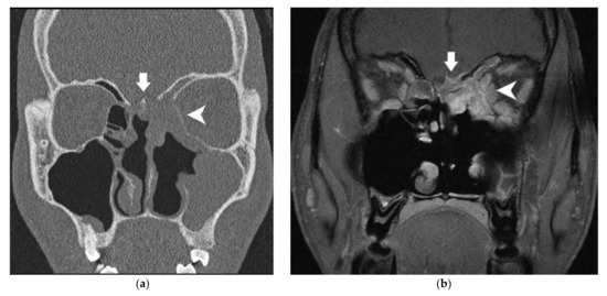 Cancers | Free Full-Text | Imaging of Skull Base and Orbital Invasion in Sinonasal Cancer ...