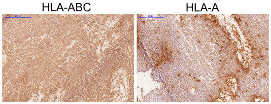 Copy Neutral LOH Affecting the Entire Chromosome 6 Is a Frequent ...