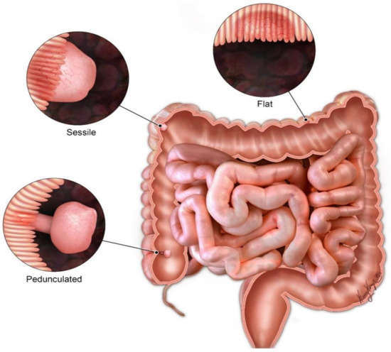 Peutz–Jeghers Syndrome and the Role of Imaging: Pathophysiology ...