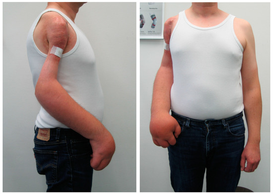 Amputation for Extremity Sarcoma: Indications and Outcomes