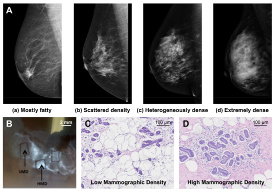 Biological Mechanisms and Therapeutic Opportunities in Mammographic ...