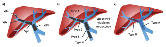 Locoregional Therapies for Hepatocellular Carcinoma with Portal Vein ...