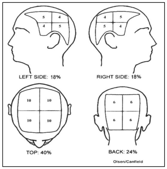 Cancer-Related Alopecia: From Etiologies to Global Management
