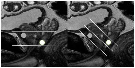 How to Improve TRUS-Guided Target Biopsy following Prostate MRI