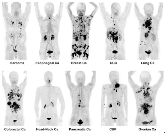 Radioligands Targeting Fibroblast Activation Protein (FAP)