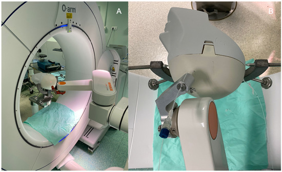 Interstitial Photodynamic Therapy for Glioblastomas: A Standardized ...