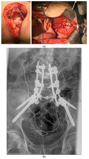 Opportunities and Limitations of Pelvic Exenteration Surgery