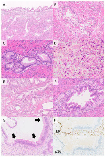 Molecular Pathology of Human Papilloma Virus-Negative Cervical Cancers